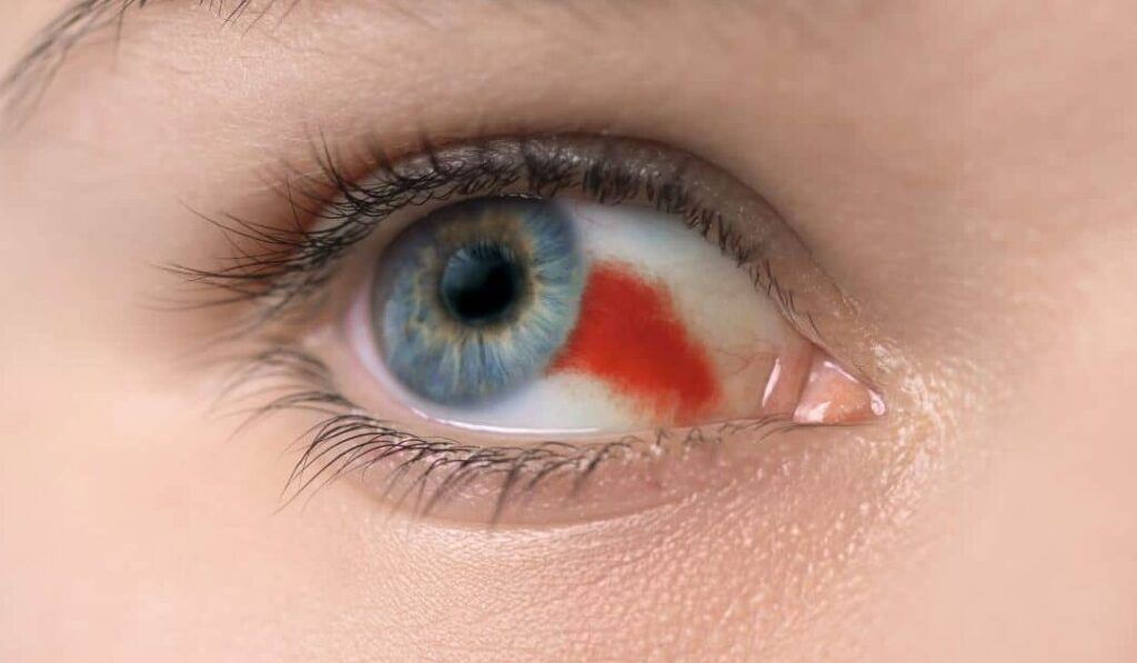 ¿Cuánto tarda en irse un derrame en el ojo? Descúbrelo aquí