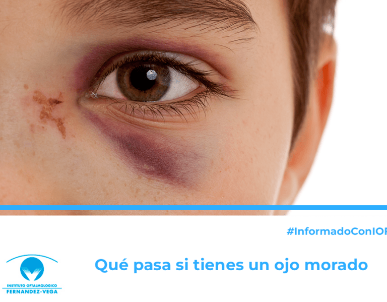 Hematoma en el párpado superior sin golpe: causas y tratamiento