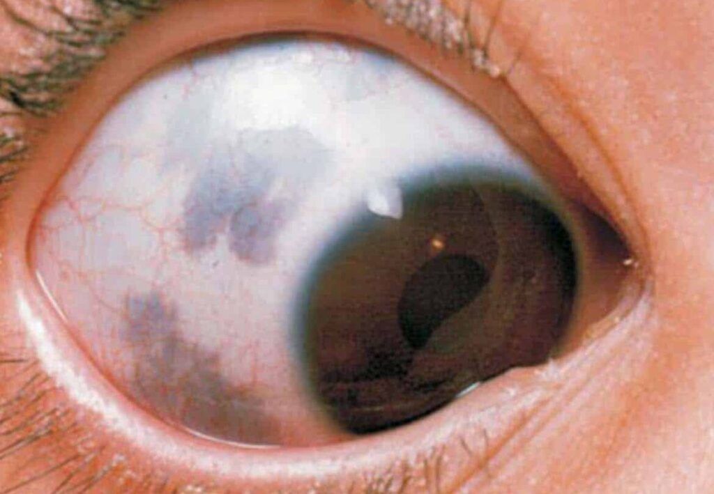 Mancha gris en lo blanco del ojo: causas y tratamiento