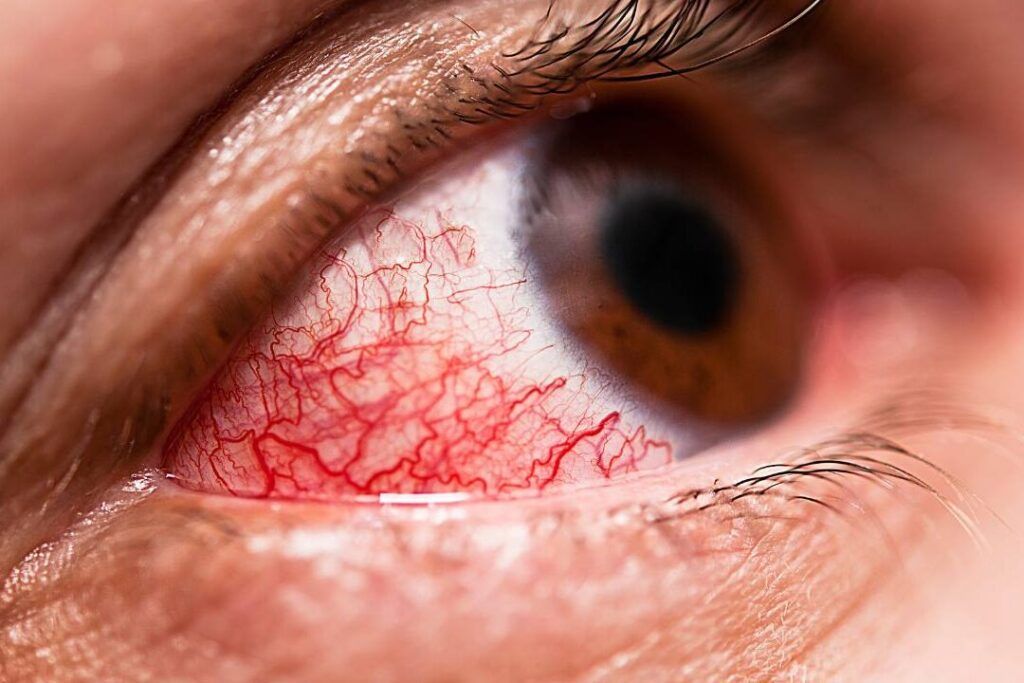 Síntomas de conjuntivitis en adultos: Ojo rosado y sus causas