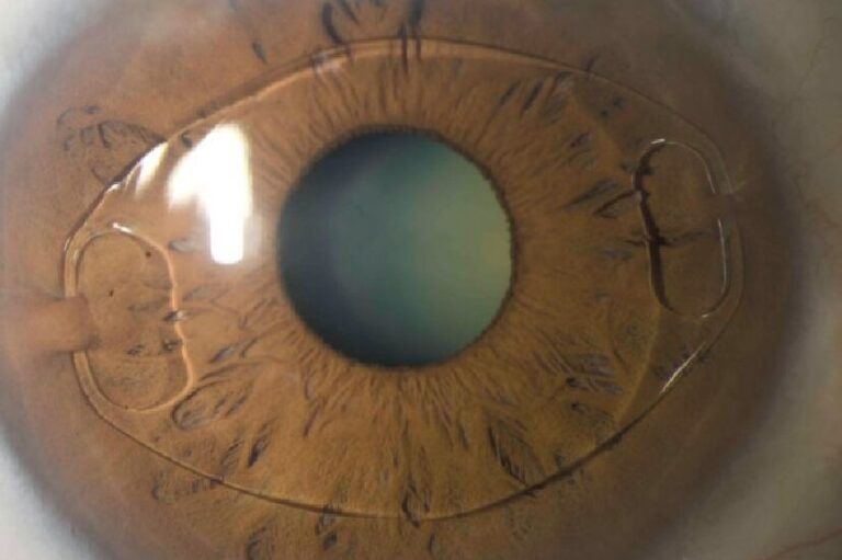 Qué pasa si se rompe el lente intraocular: riesgos y tratamiento