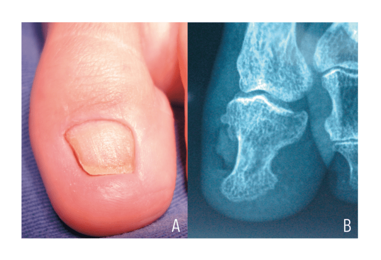 Cómo saber si tengo exostosis: síntomas y tratamiento